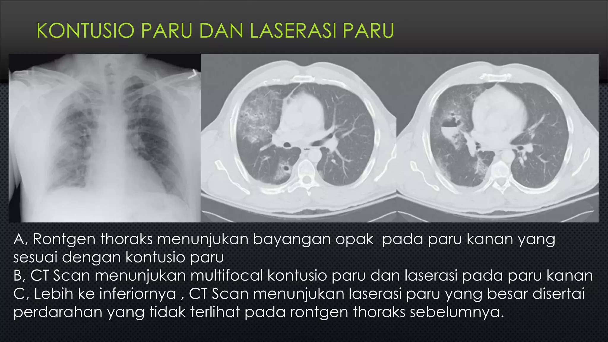 Imejing Trauma Thoraks, Indra Kelana Sp.Rad
