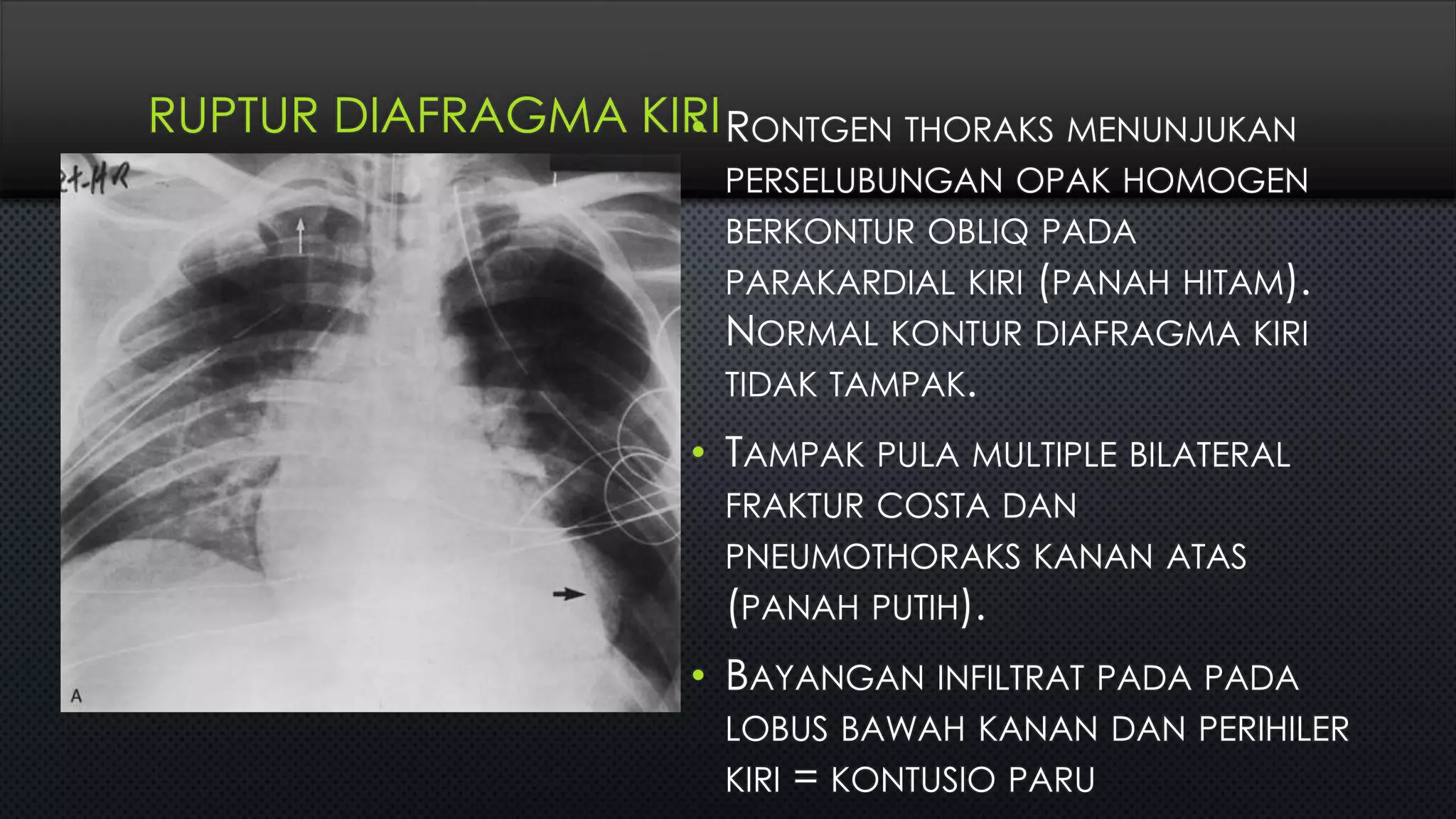 Imejing Trauma Thoraks, Indra Kelana Sp.Rad