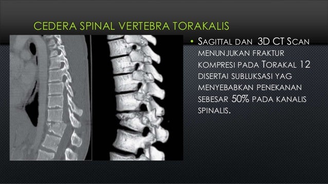 Imejing Trauma Thoraks, Indra Kelana Sp.Rad
