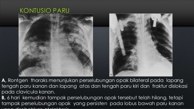 Imejing Trauma Thoraks, Indra Kelana Sp.Rad