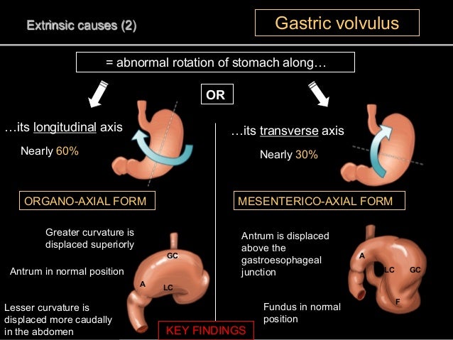 Jm tubiana p taourel mdct in upper gastrointestinal obstruction jfim