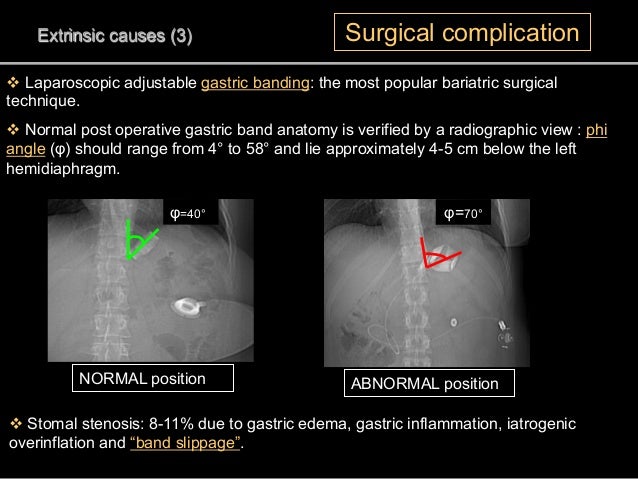 Jm tubiana p taourel mdct in upper gastrointestinal obstruction jfim