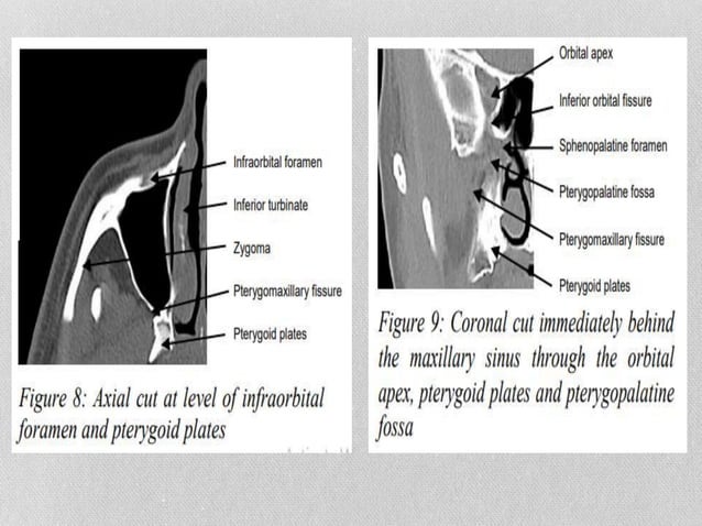 JNA | PPTX | Ear, Nose and Throat Conditions | Diseases and Conditions