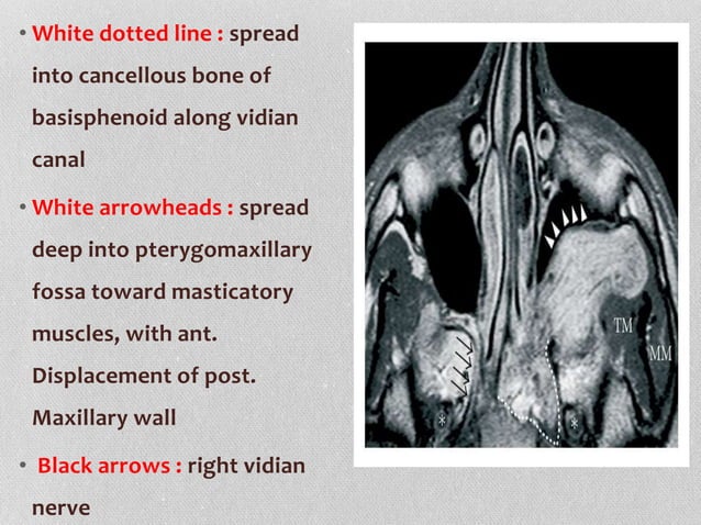 JNA | PPTX | Ear, Nose and Throat Conditions | Diseases and Conditions