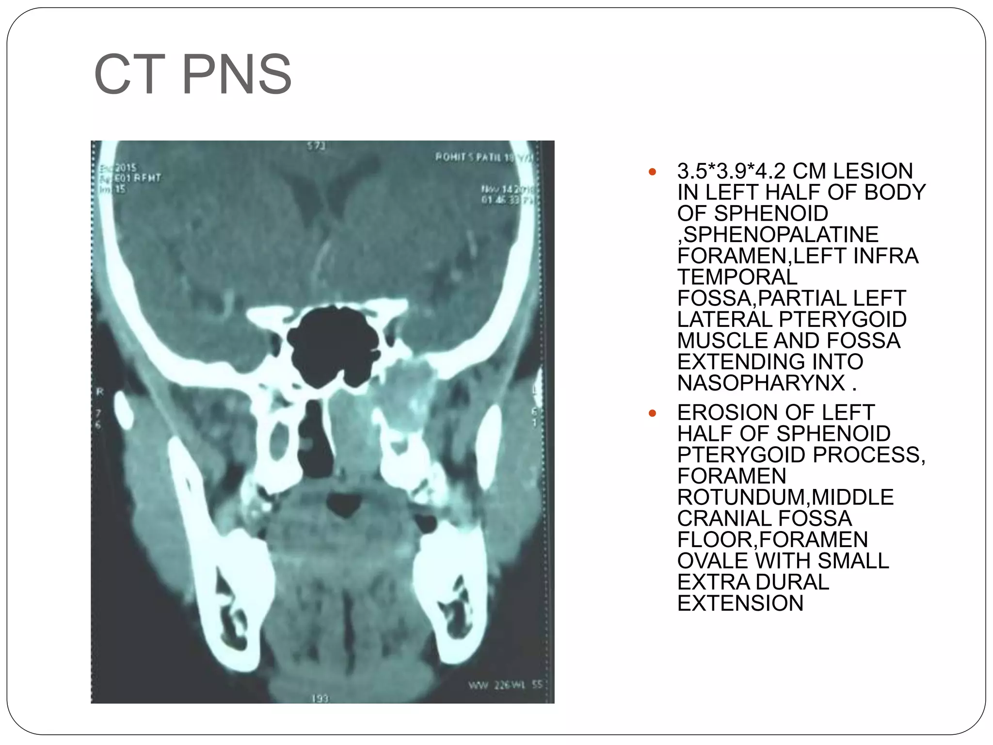 jna case report.pptx | Ear, Nose and Throat Conditions | Diseases and Conditions