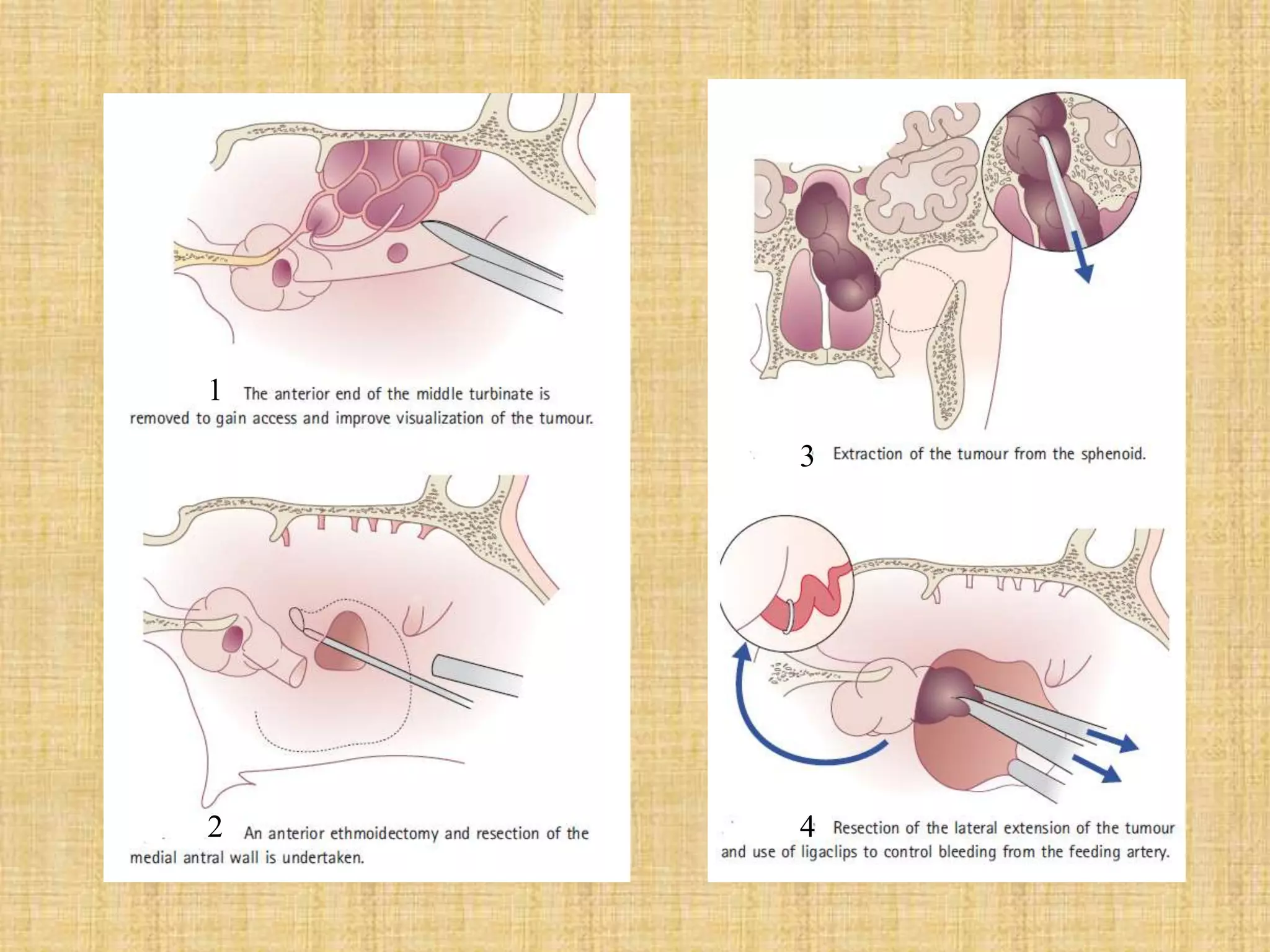 Jna(juvenile nasopharyngeal angiofibroma) current treatment modalities | PPTX