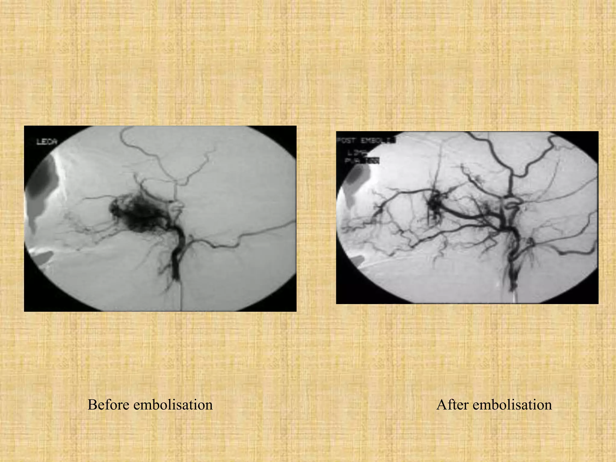 Jna(juvenile nasopharyngeal angiofibroma) current treatment modalities ...