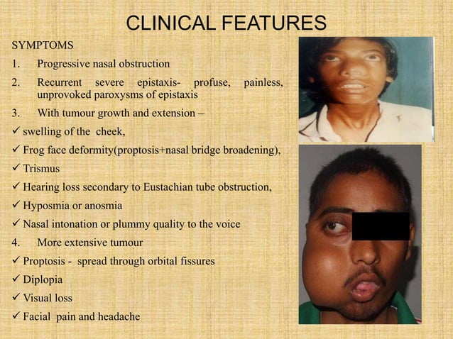Jna(juvenile nasopharyngeal angiofibroma) current treatment modalities ...