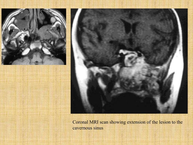 Jna(juvenile nasopharyngeal angiofibroma) current treatment modalities ...