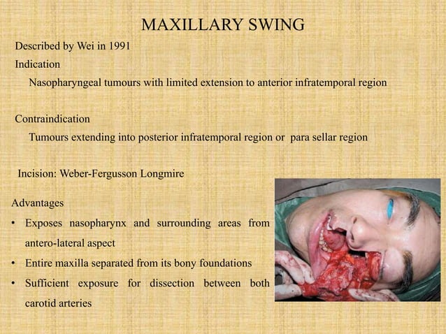 Jna(juvenile nasopharyngeal angiofibroma) current treatment modalities | PPTX