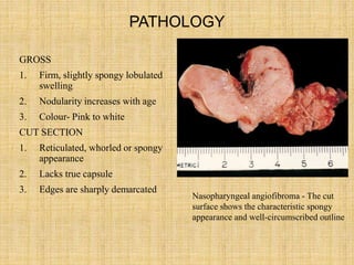 Jna(juvenile nasopharyngeal angiofibroma) current treatment modalities ...