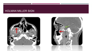 JUVENILE NASOPHARYNGEAL ANGIOFIBROMA Surgical approaches & newer ...