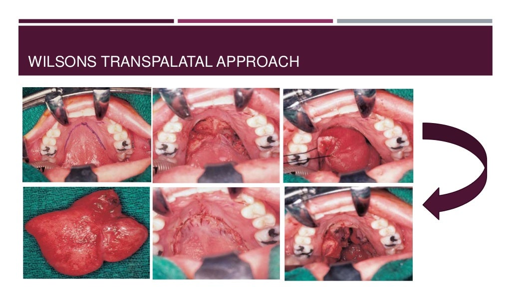 JUVENILE NASOPHARYNGEAL ANGIOFIBROMA Surgical approaches & newer tre…