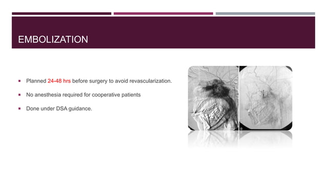 JUVENILE NASOPHARYNGEAL ANGIOFIBROMA Surgical approaches & Newer ...