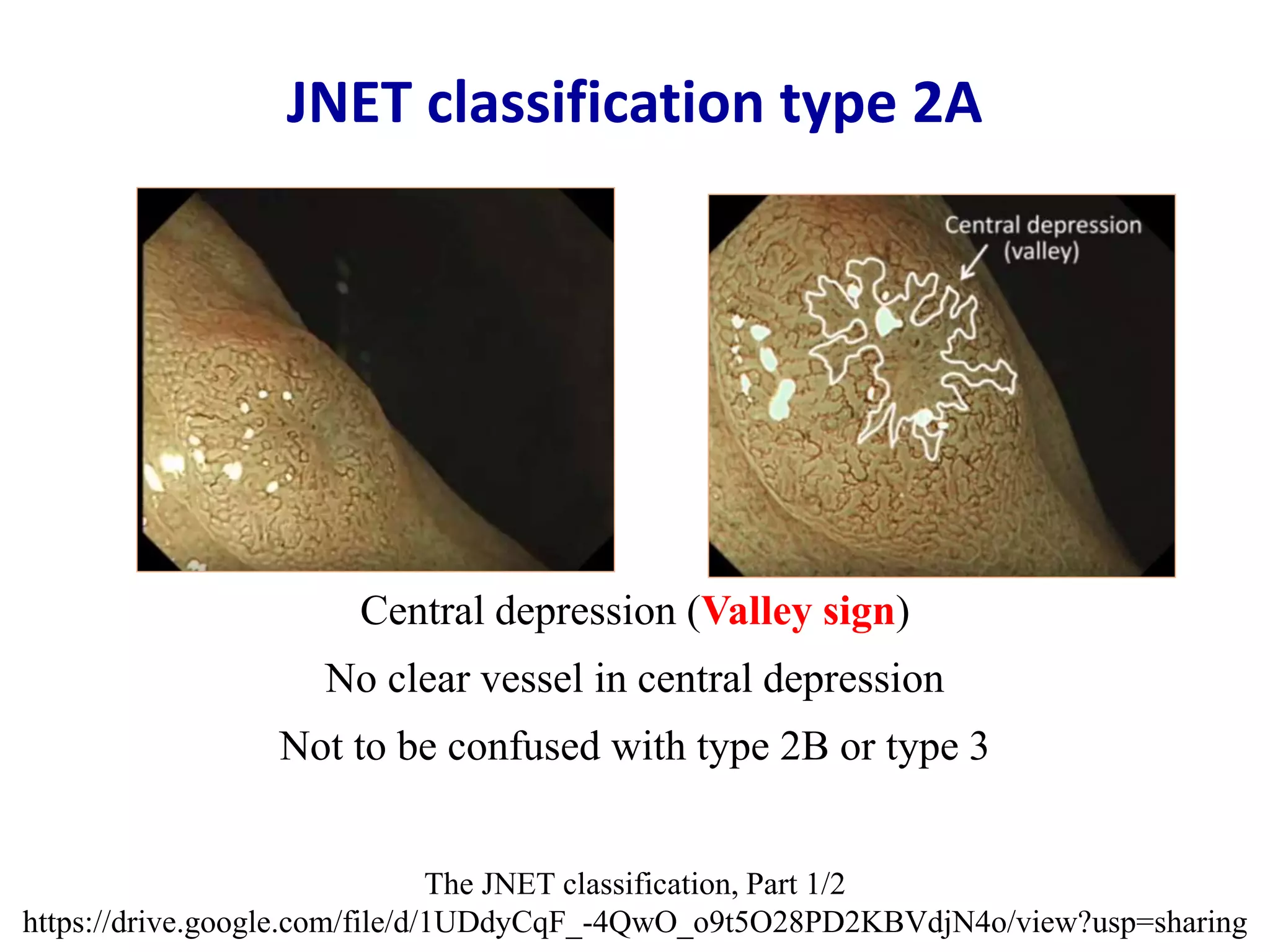 JNET classification of colo rectal polyps | PPTX