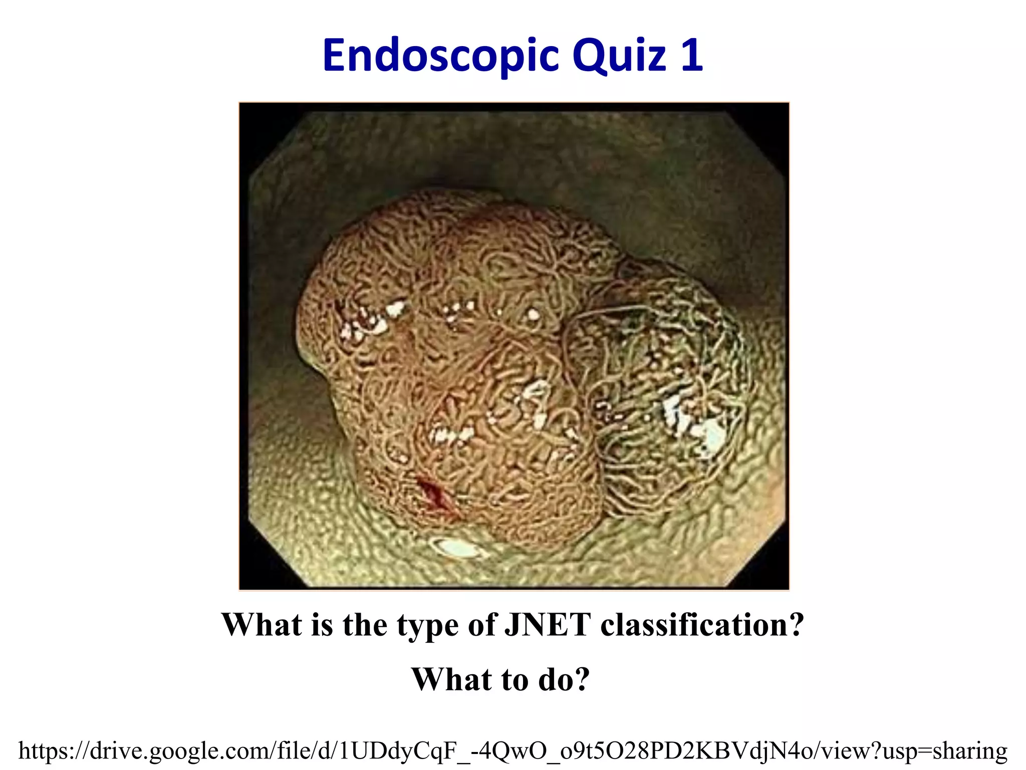 JNET classification of colo rectal polyps | PPTX