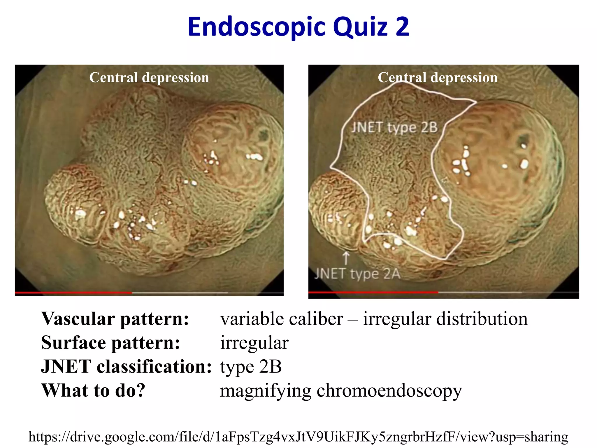 JNET classification of colo rectal polyps | PPTX