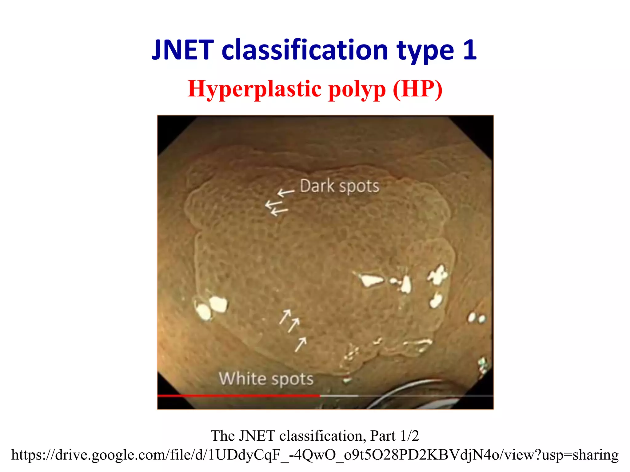 JNET classification of colo rectal polyps | PPTX
