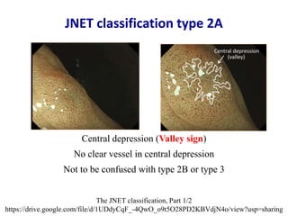 JNET classification of colo rectal polyps | PPTX