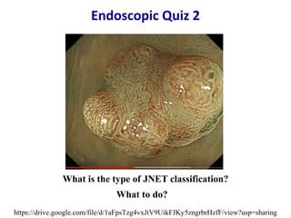 JNET classification of colo rectal polyps | PPTX
