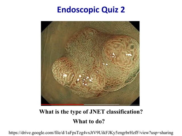 JNET classification of colo rectal polyps | PPTX | Medical Health