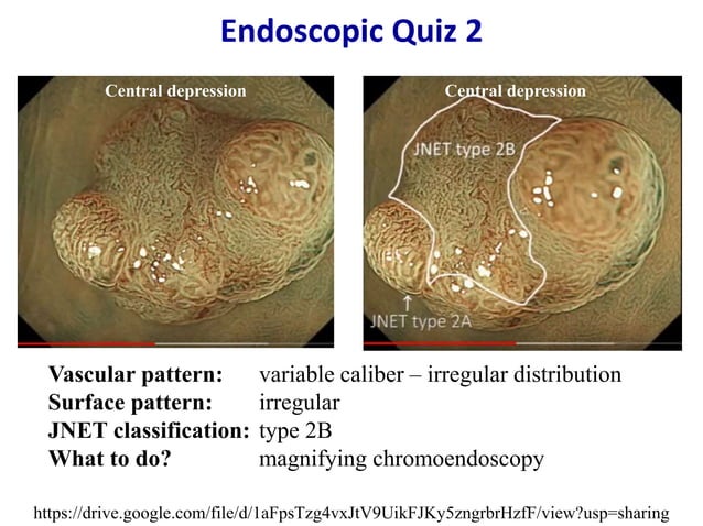 JNET classification of colo rectal polyps | PPTX | Medical Health