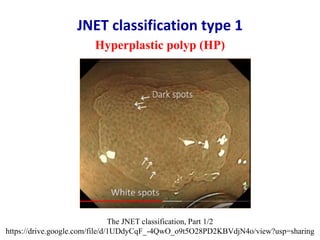 JNET classification of colo rectal polyps | PPTX