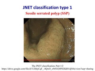 JNET classification of colo rectal polyps | PPTX