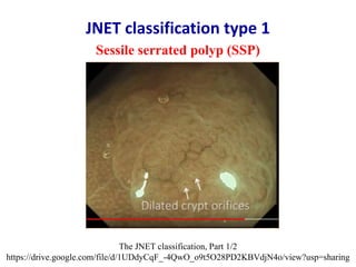 JNET classification of colo rectal polyps | PPTX