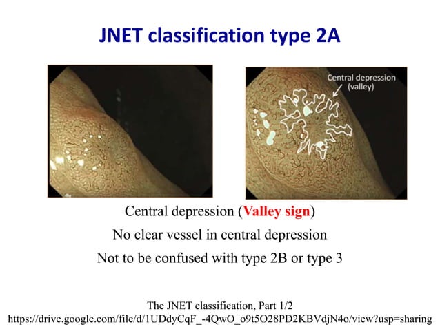 JNET classification of colo rectal polyps
