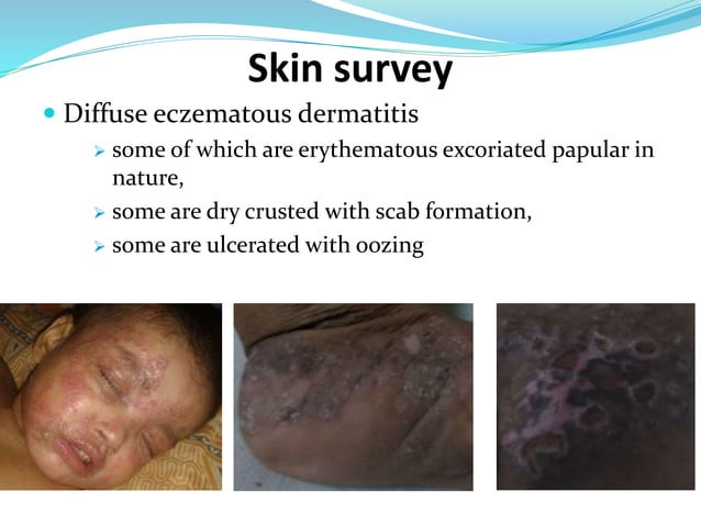 Job syndrome | PPTX | Ear, Nose and Throat Conditions | Diseases and ...