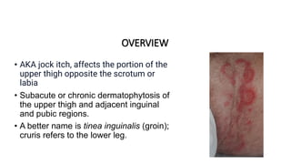 complain of itchiness on the inguinals with redness | PDF