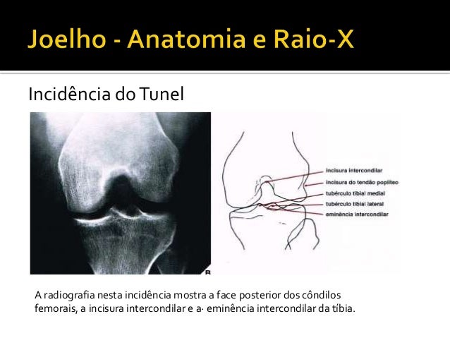 Radiografia Da Fossa Intercondilar
