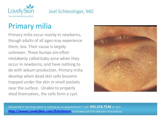 Joel Schlessinger MD FAQ - Milia
