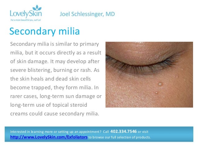 Joel Schlessinger MD FAQ - Milia