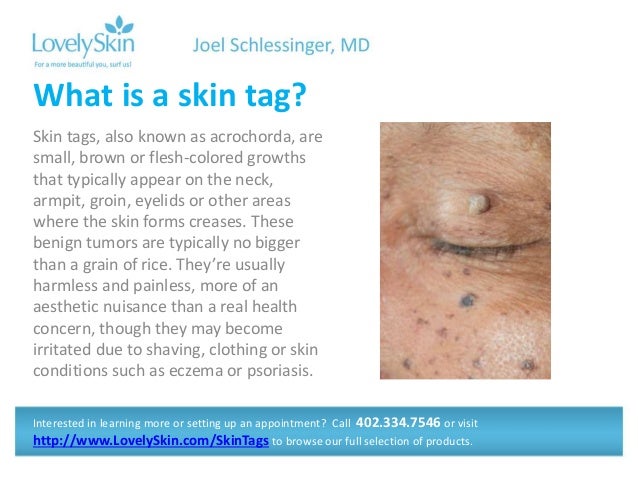 Joel Schlessinger MD FAQ - Skin Tags