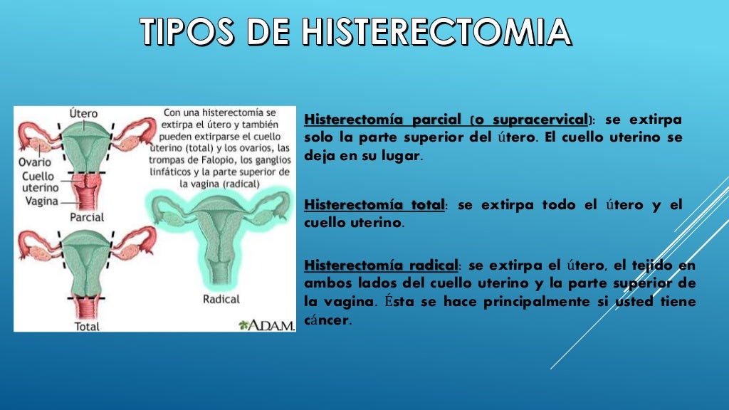 Histerectomia Paso por Paso