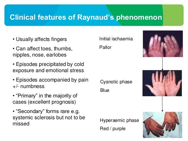 Raynaud’s phenomenon in systemic sclerosis: Why do the blood vessels