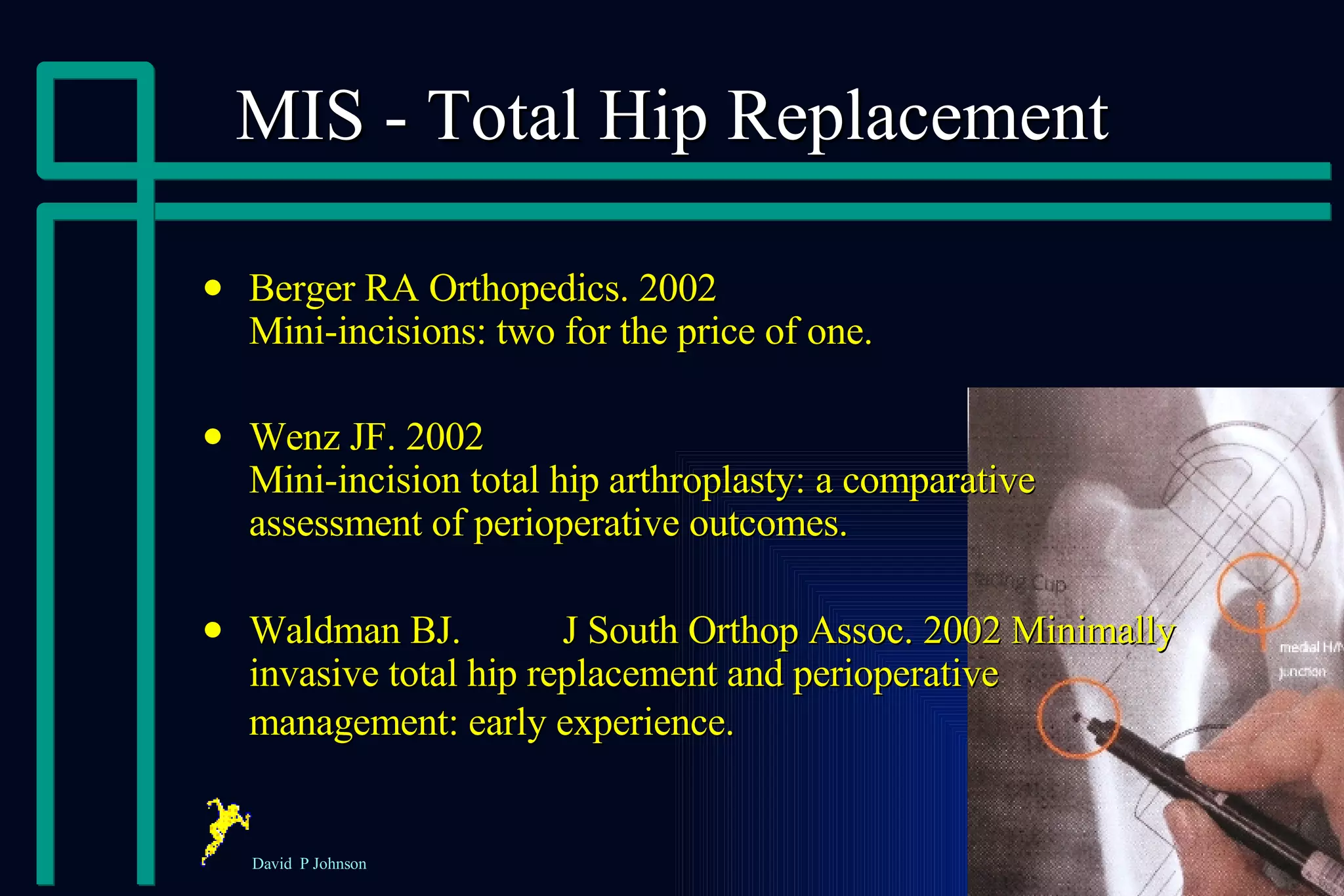 Johnson Dp. Mis Knee Replacement. What Are The Functional Benefits ...
