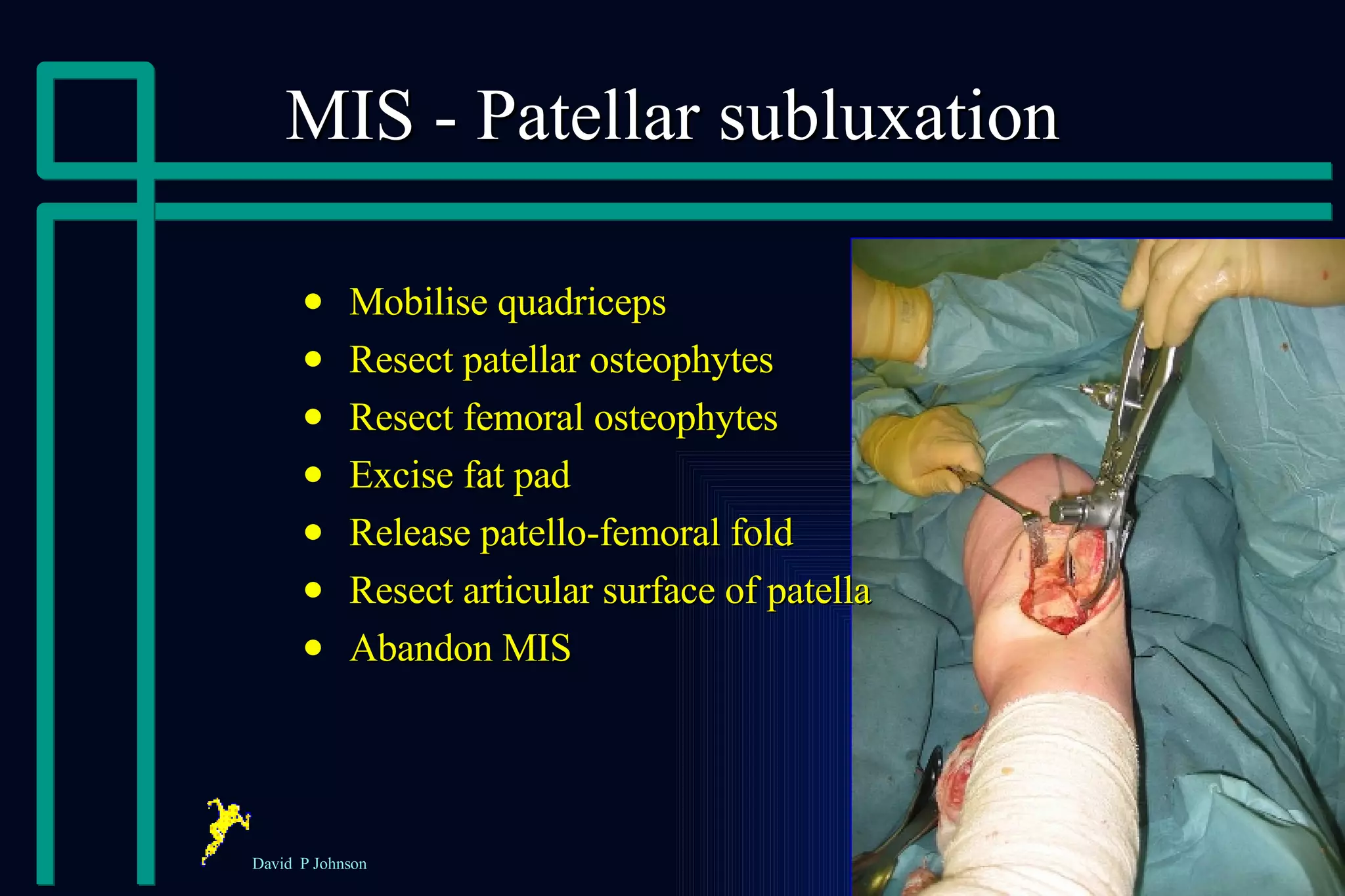 Johnson Dp. Mis Knee Replacement. What Are The Functional Benefits. Slide 1 18 | PPT