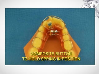 EXPANSION SCREWS | PPT