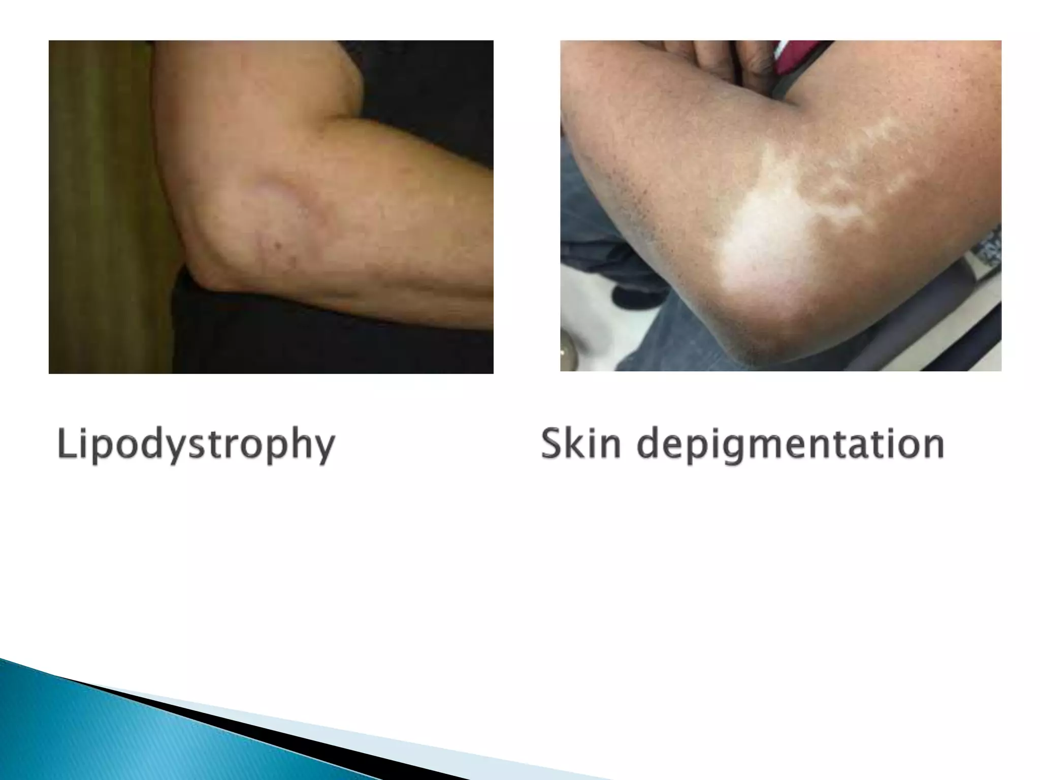 Joint and soft tissue injections | PPTX