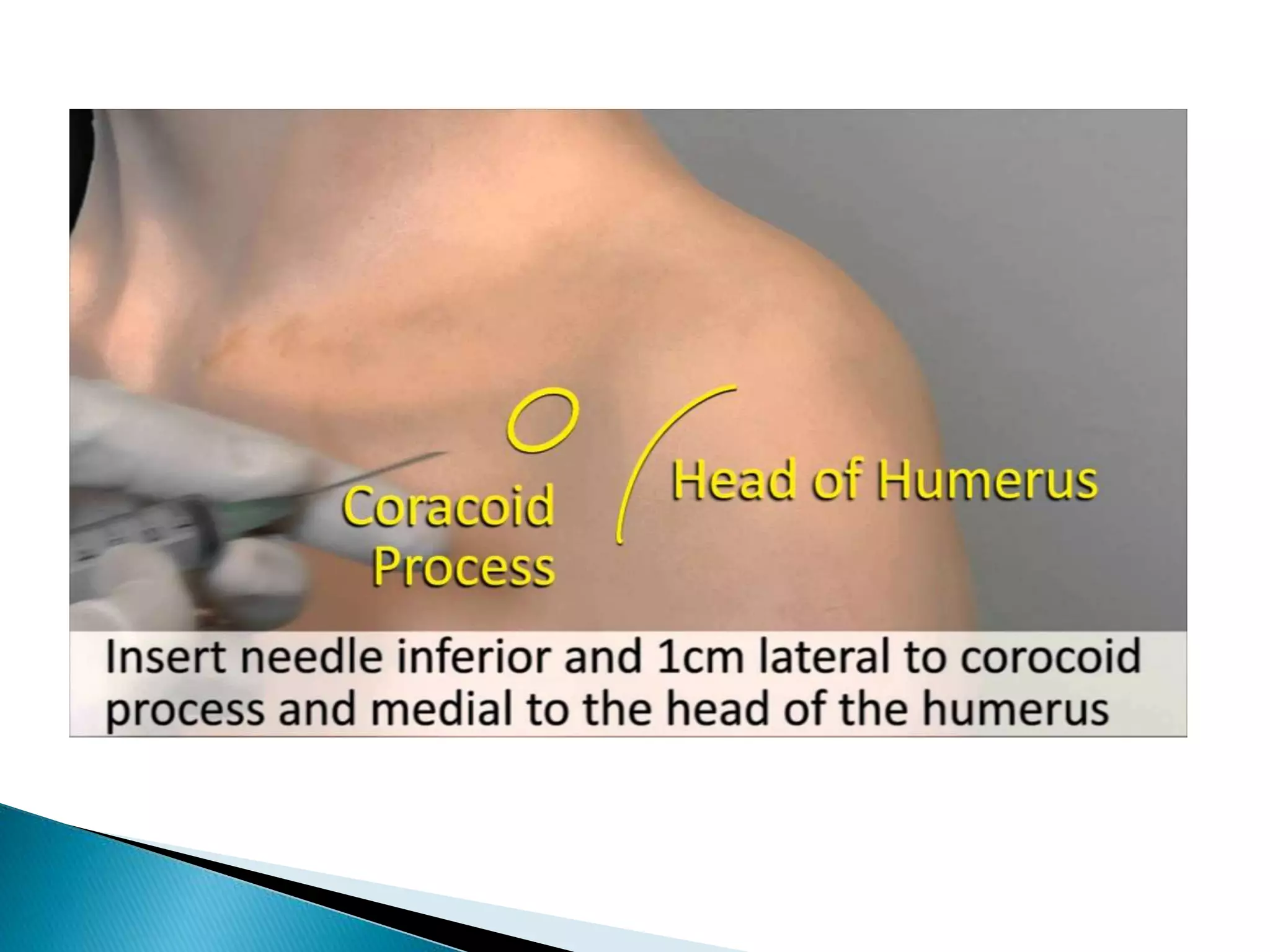 Joint and soft tissue injections | PPTX