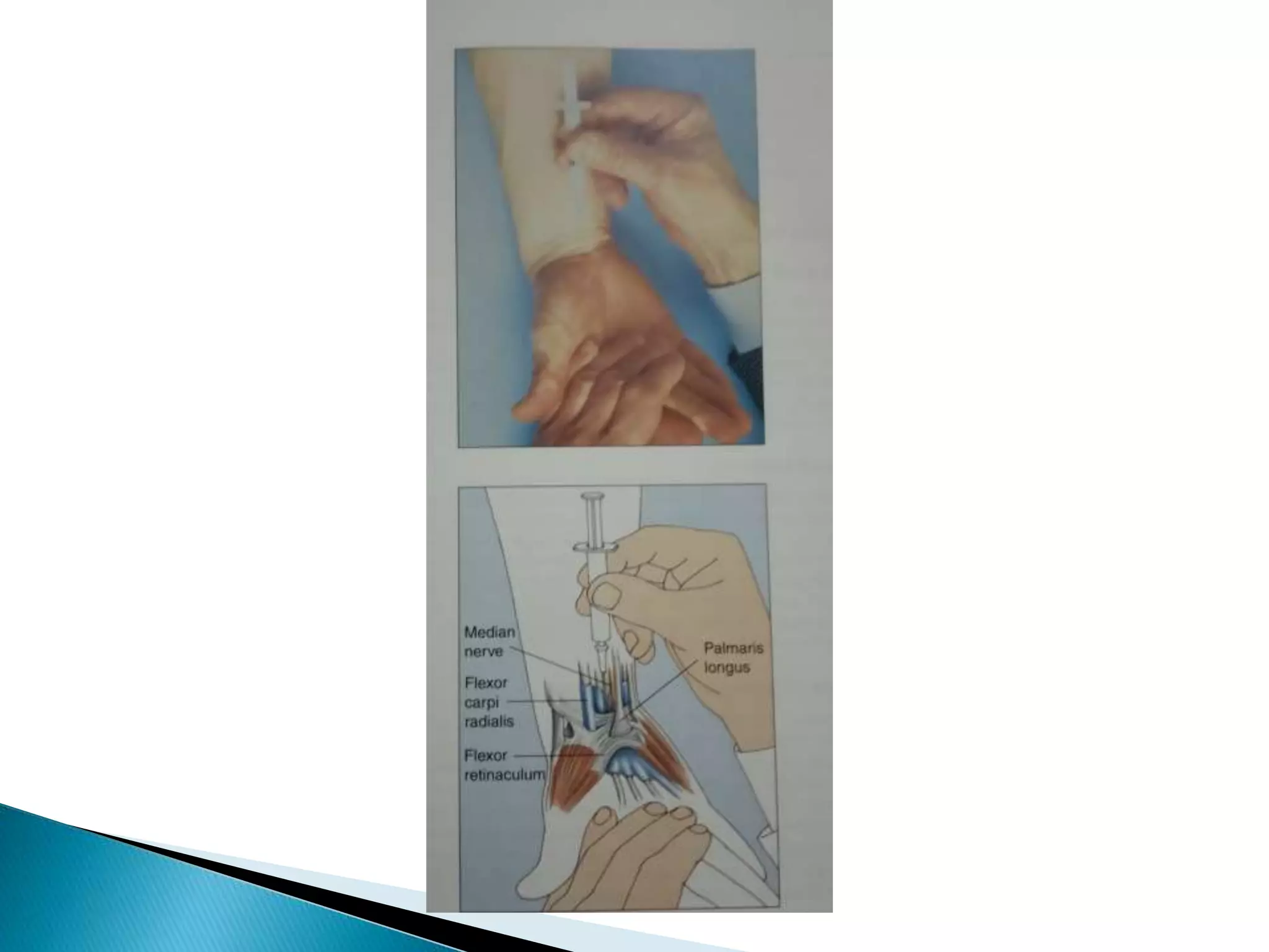 Joint and soft tissue injections | PPTX