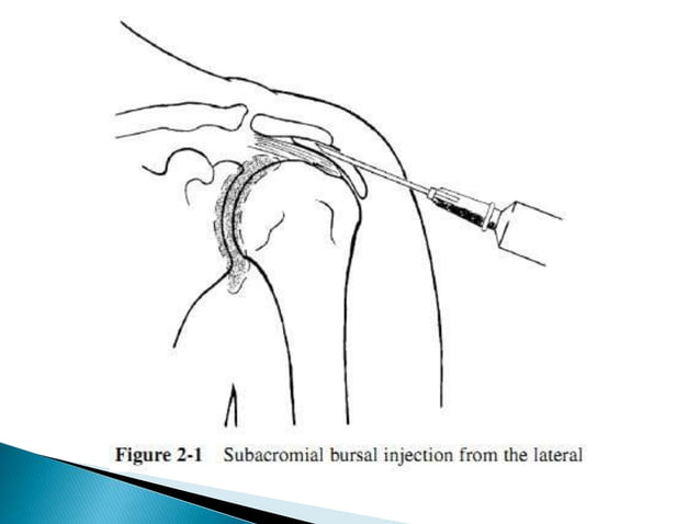 Joint and soft tissue injections | PPTX