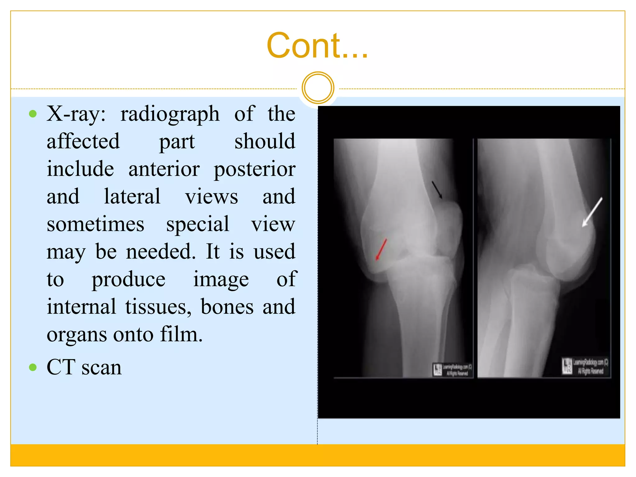 Joint dislocation | PPTX