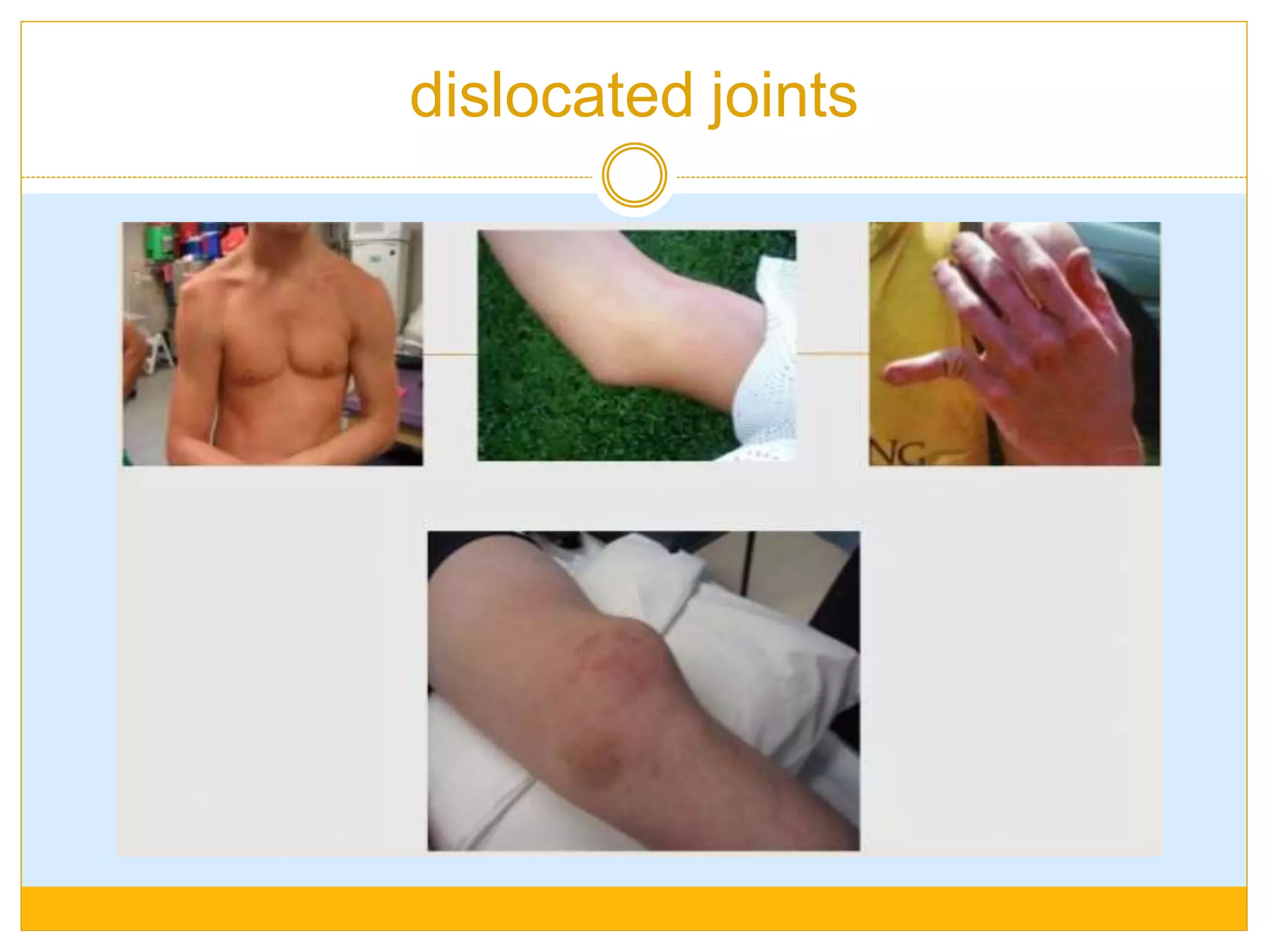 Joint dislocation | PPTX