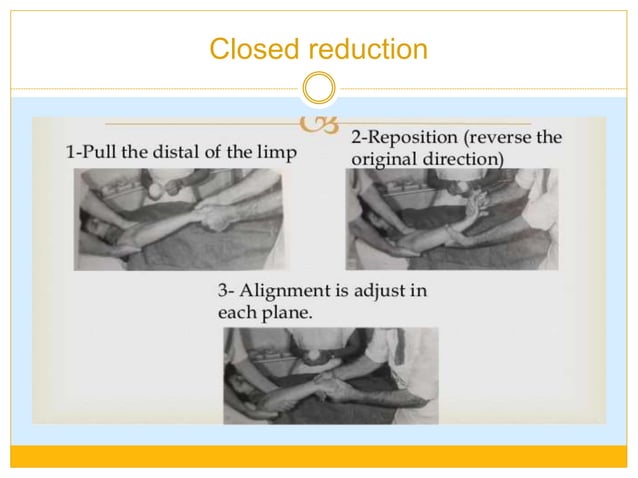 Joint dislocation | PPTX | First Aid | Injuries