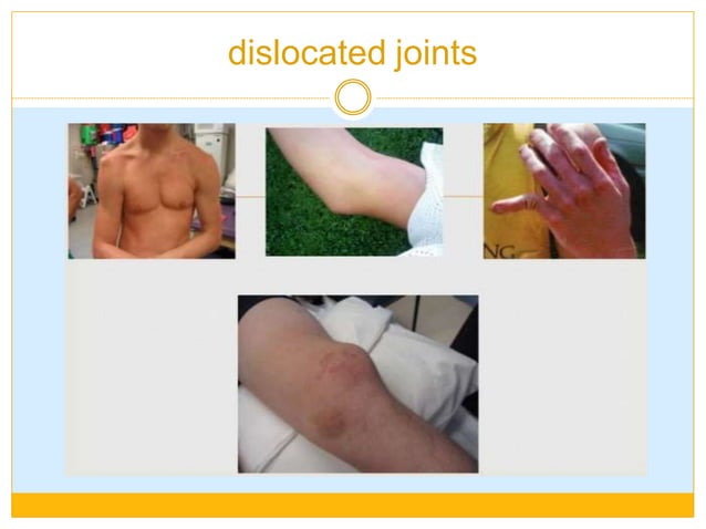Joint dislocation | PPTX | First Aid | Injuries