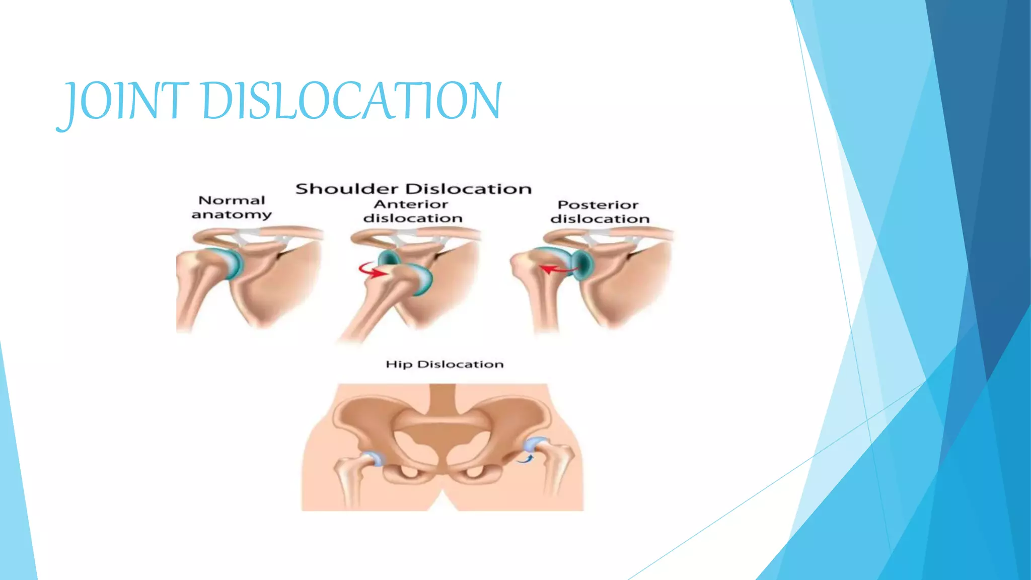 JOINT DISLOCATION.pptx